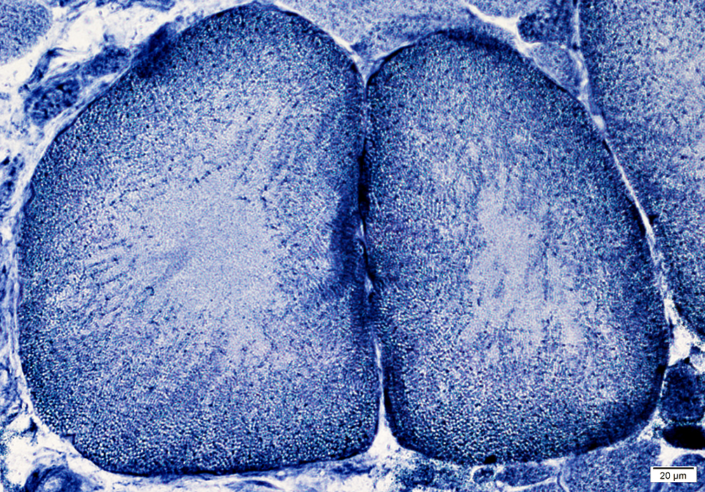 FSH Dystrophy
