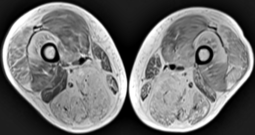 Muscle MRI